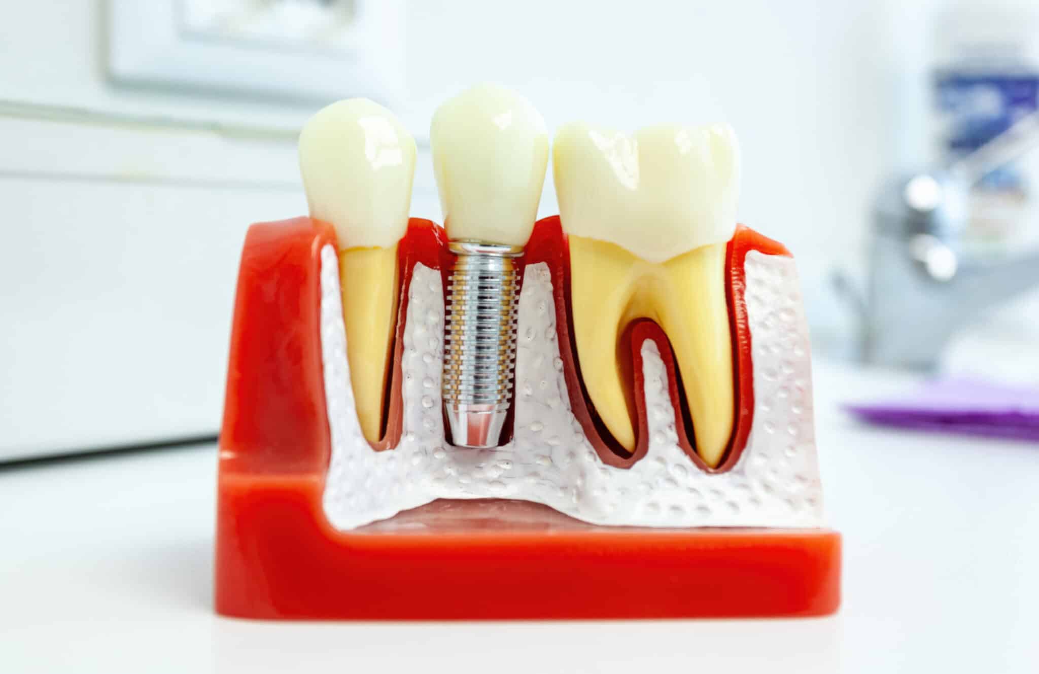 How to Clean Dental Implants: A Practical Guide